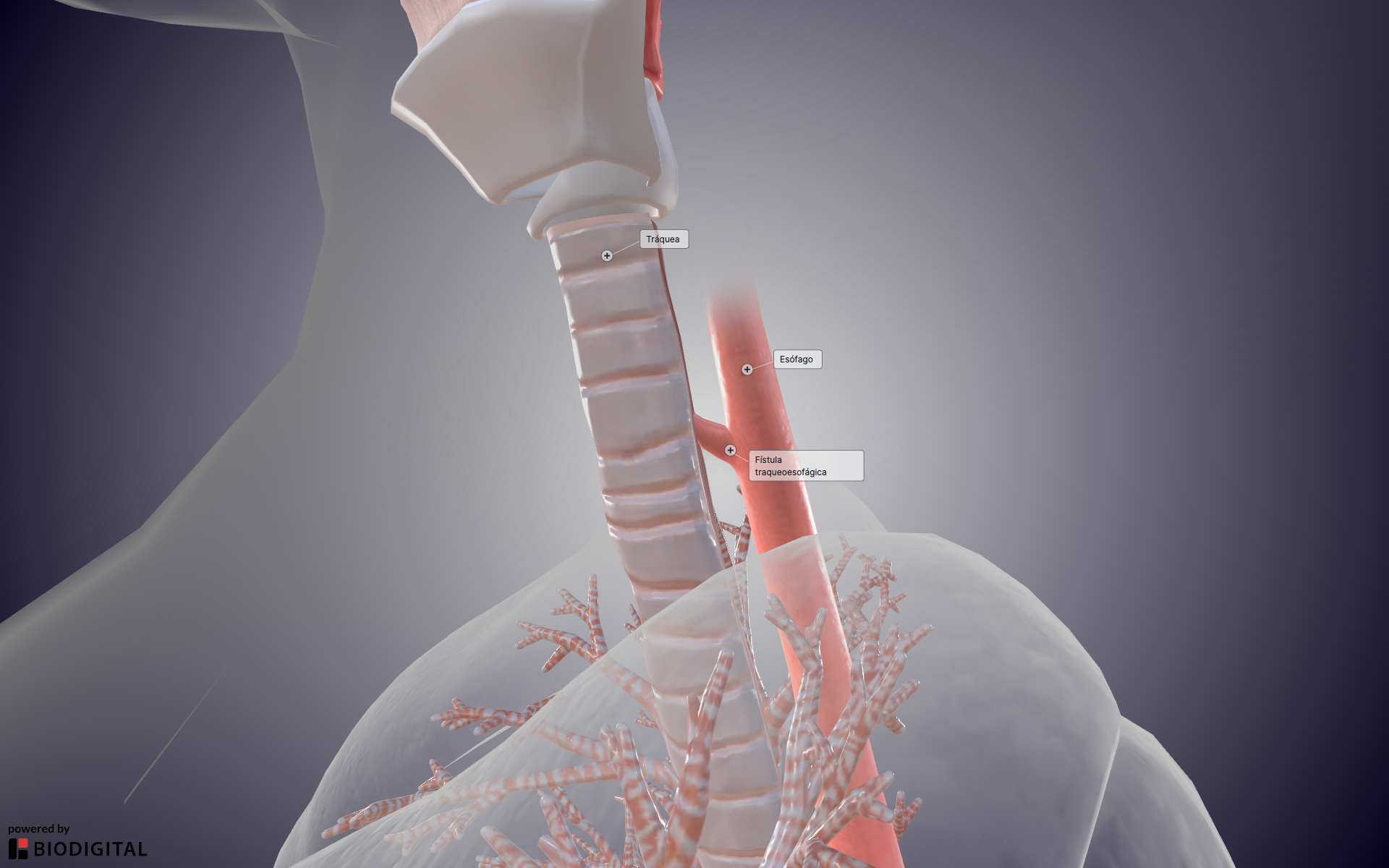Fístula traqueoesofágica - Instituto Universitario Vive Sano